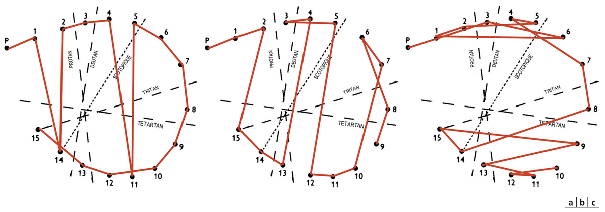 Rapport SFO 2016 - Œdèmes maculaires